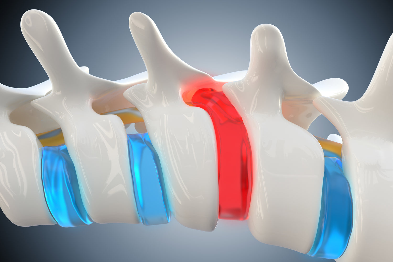 Disc Herniation – Schneider Clinic